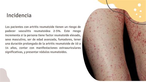 Solution Vaculitis Reumatoide Studypool