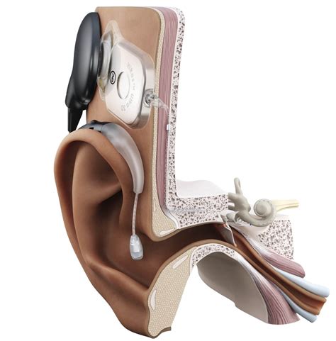Understanding The Cochlear Implant Process From Evaluation To Candidacy Advanced Bionics