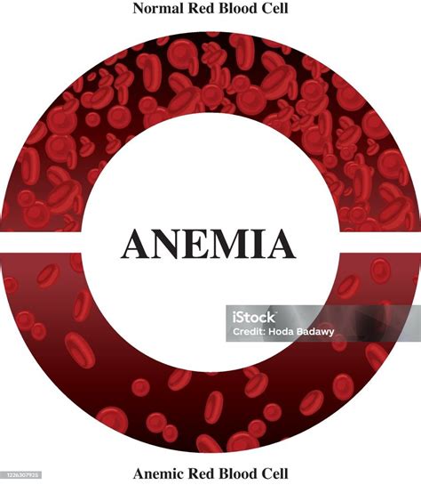 세계 혈우병의 날 적혈구 철 결핍 빈혈의 양과 정상 증상 벡터 일러스트 의학 건강관리와 의술에 대한 스톡 벡터 아트 및 기타
