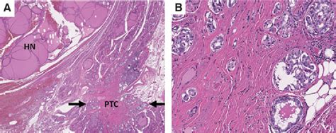 Figure 1 From Performance Of A Multigene Genomic Classifier In Thyroid