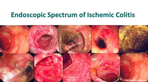 Endoscopic Signs Of Ischemic Colitis Stages Klaus Mönkemüller Posted
