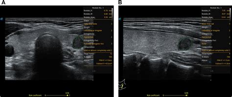 A 37 Year Old Woman With A Thyroid Nodule And Pathological Findings Download Scientific