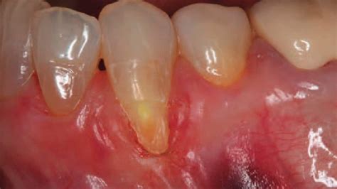 root coverage features decisions in dentistry