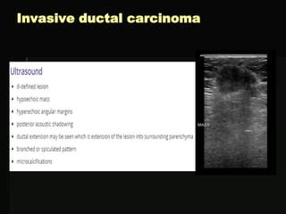Ultrasound Of Breast Pptx