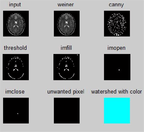 Figure3 Feature Extraction Of Brain Tumor For Normal Mri Image Euler Download Scientific