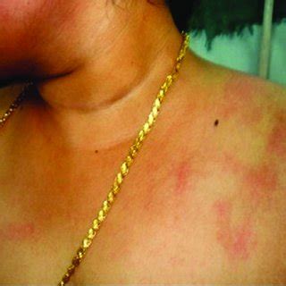 Diffuse Ill Defined Erythematous Rash Involving The Left Side Of The Download Scientific