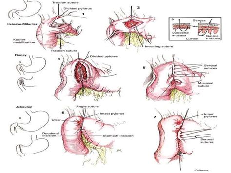 Gastric Perforation General Surgerypptx
