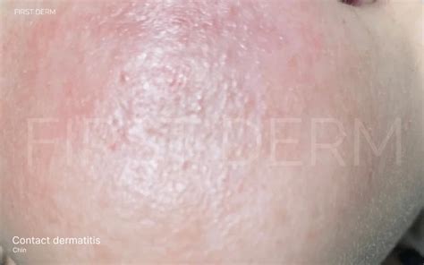 Dry Patches On Your Face Pictures Causes And Treatments First Derm