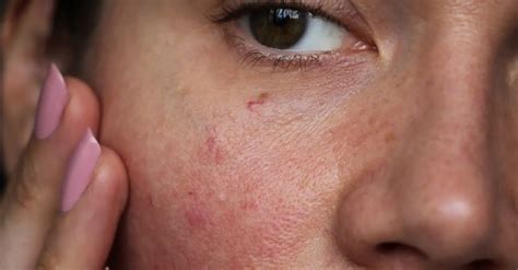 Sensitive Skin Dr Suruchi Puri