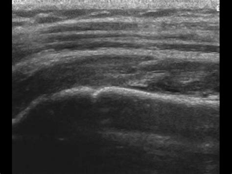 Musculoskeletal Joints And Tendons 6 1 Shoulder Case 6 1 2 Biceps