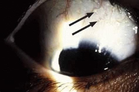 Parinauds Oculoglandular Syndrome Ento Key