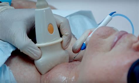 Microwave Ablation Feasible For Treating Papillary Thyroid Microcarcinoma