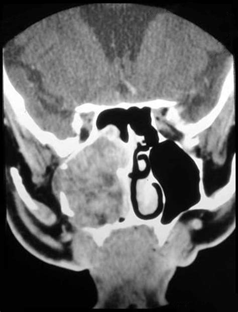 Temporalis Muscle Transposition Clinical Tree Temporalis Muscle Transposition Clinical Tree