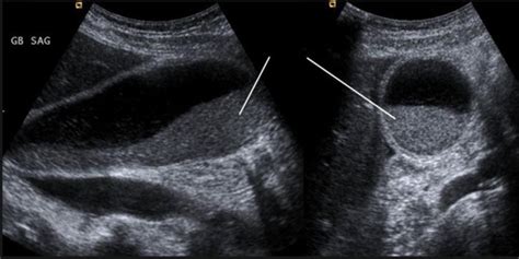 Gallbladder Pathology Images Quiz Flashcards Quizlet