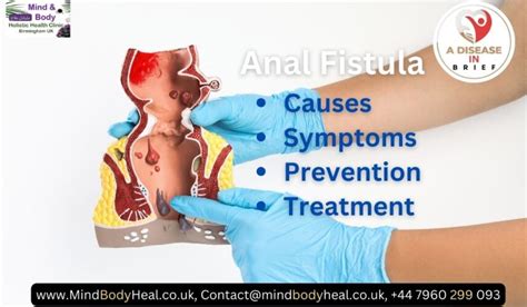 13 Fistula Anal Anal Fistula What It Is Symptoms Treatment