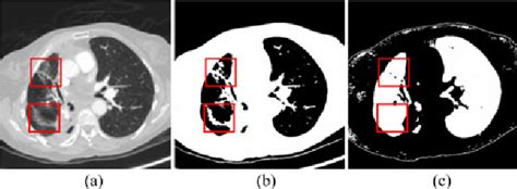 Figure 4 From Fast And Adaptive Detection Of Pulmonary Nodules In Thoracic Ct Images Using A