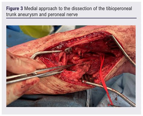 A Rare Case Of True Tibioperoneal Trunk Aneurysm Resulting In Foot Drop Journal Of Vascular