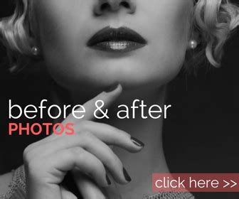 Labiaplasty Before And After Photo Gallery