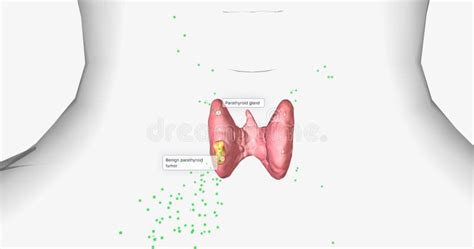 Hyperparathyroidism Is A Condition In Which High Amounts Of Parathyroid Hormone Are Produced By