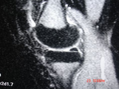 Msk Distal Femoral Cortical Defect Or Non Ossifying Fibroma And