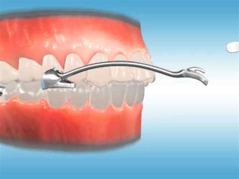 Carriere® Motion Appliance Being Placed With An Essix Appliance Youtube