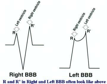 Bundle Branch Blocks Nursing Babe Studying Nursing Babe Notes Nursing Study Nursing