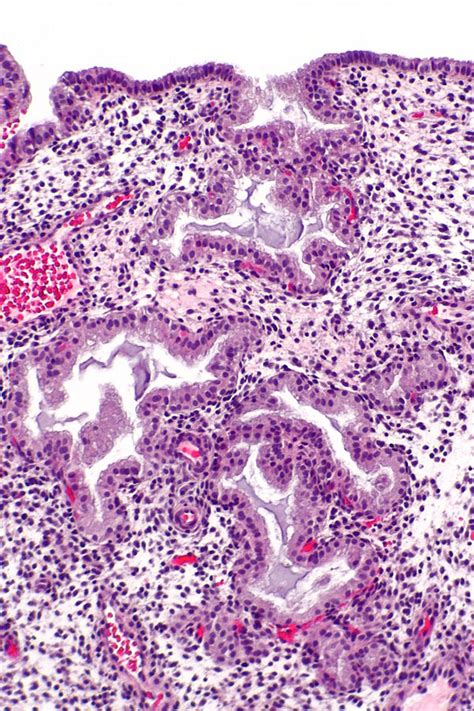 Secretory Phase Endometrium Libre Pathology