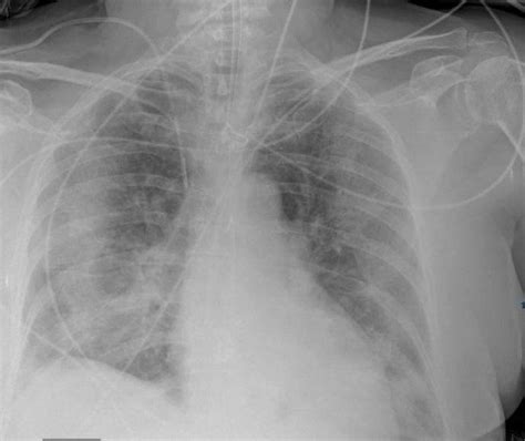 A 71 Year Old Female With Sars Cov 2 Cxr Shows Extensive Parenchymal Download Scientific