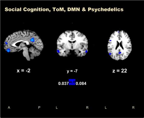 overlap of brain activation between social cognition theory of mind