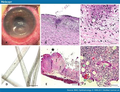 Synthetic Fiber Causing Keratitis And Conjunctival Granuloma Page 3
