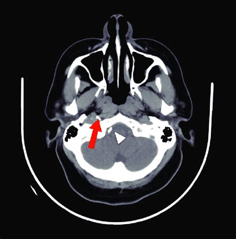 Computed Tomography Brain Plain Post Embolization Demonstrates Glue