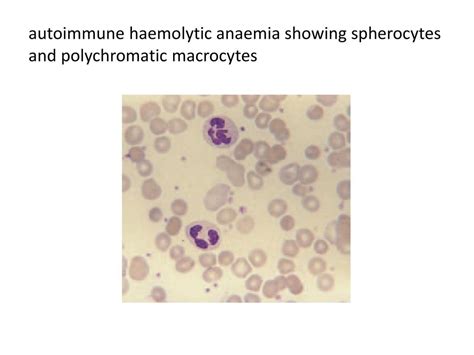 Acquired Haemolytic Anaemia Ppt Download