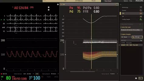 Philips Hemo With Intellivue X3 Interventional Hemodynamic Monitoring