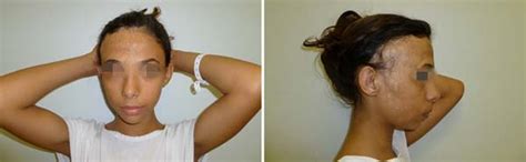 RBCP Scalp Reconstruction With Expanded Flap