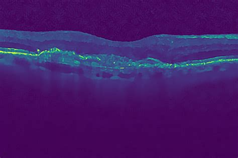 Amd Classification Dataset And Pre Trained Model By Amd