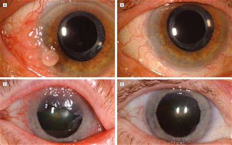 Topical Interferon Alfa 2b For Management Of Ocular Surface Squamous Neoplasia In 23 Cases