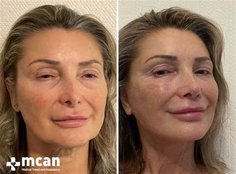 Facelift Turkey Rhytidectomy Surgery Cost 2023