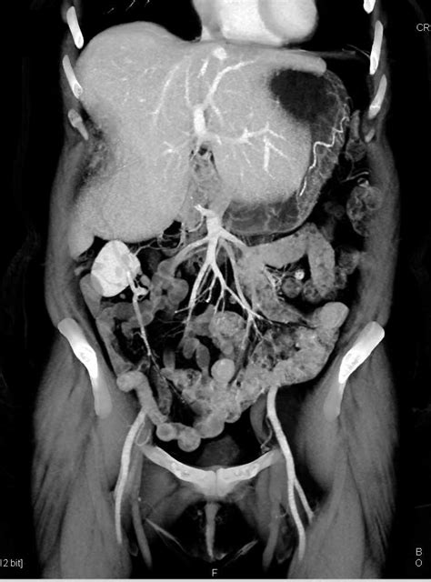 Low Grade Liposarcoma Left Thigh And Pelvis Musculoskeletal Radiology