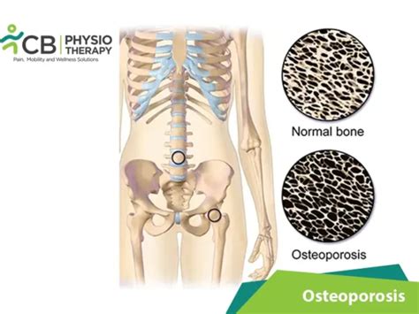 Top 5 Exercises For Osteoporosis Png