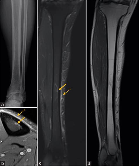 Stress Fracture X Ray Tibia