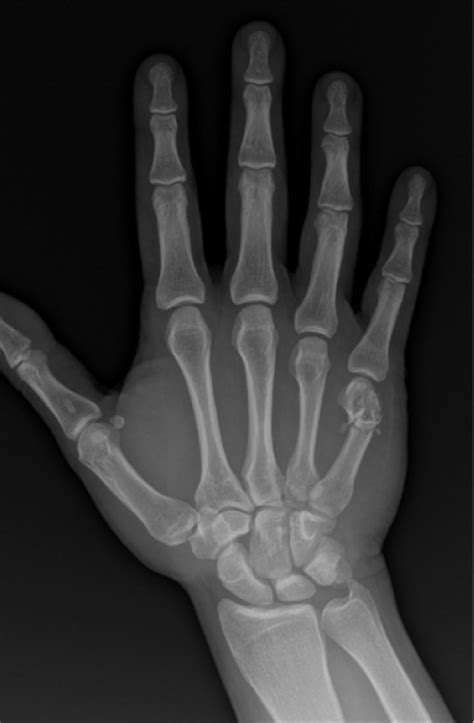 Nx Nail Fixation Of Fifth Metacarpal Fracture Involving Distal Diaphysis With Comminution
