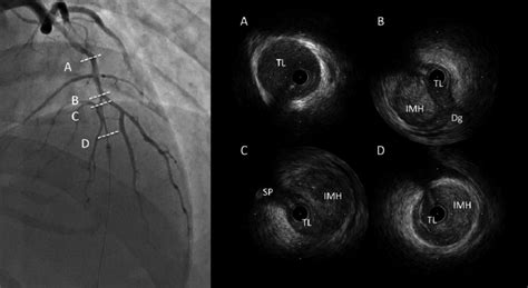 Representative Case Of Type 2 Spontaneous Coronary Artery Dissection