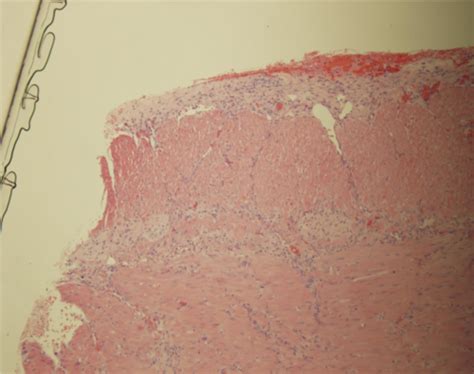 Pathology Exam 5 Intestines 1 Flashcards Quizlet