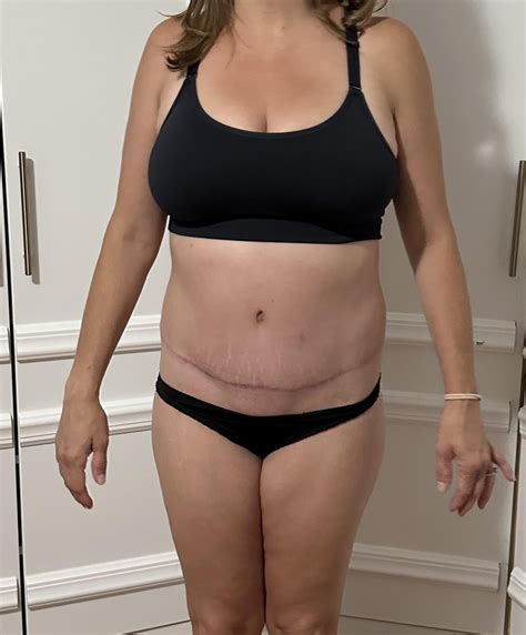 Pics Of My Tummy Tuck Progress 0 15 Weeks Rtummytucksurgery