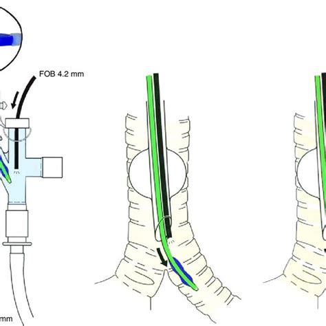 Role Of Auscultation Fiberoptic Bronchoscopy And Or Both During Lung Download Scientific