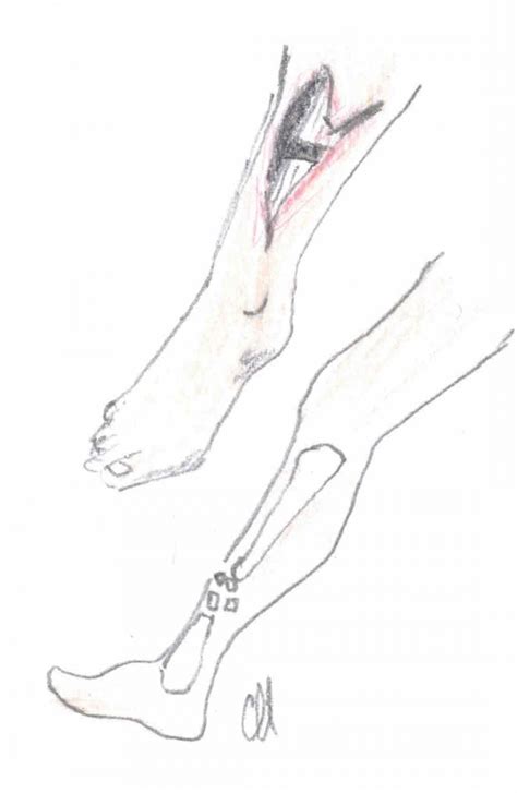 Open Fractures Gustilo Anderson Classification