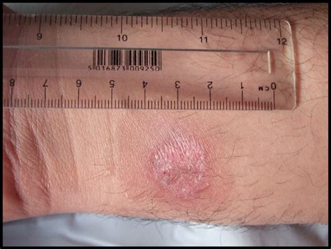 An Annular Slightly Erythematous Rash With Crust On The Surface Download Scientific Diagram