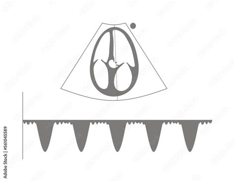 Infographic Of Echocardiography Of Left Ventricular Outflow Tract Velocity Time Integral Or LVOT