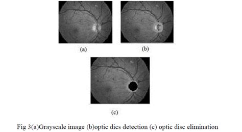 Detection Of Exudates In Color Fundus Image Open Access Journals