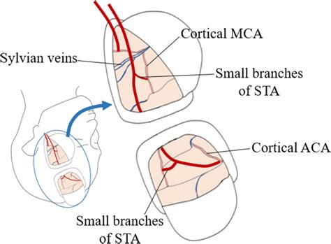 Schematic Of Staaca Bypass Aca Anterior Cerebral Artery Mca Middle Download Scientific